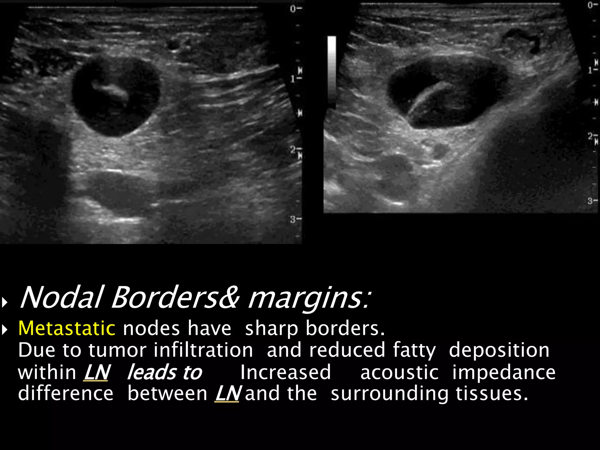 Imaging Of Cervical Lymph Nodes Ppt