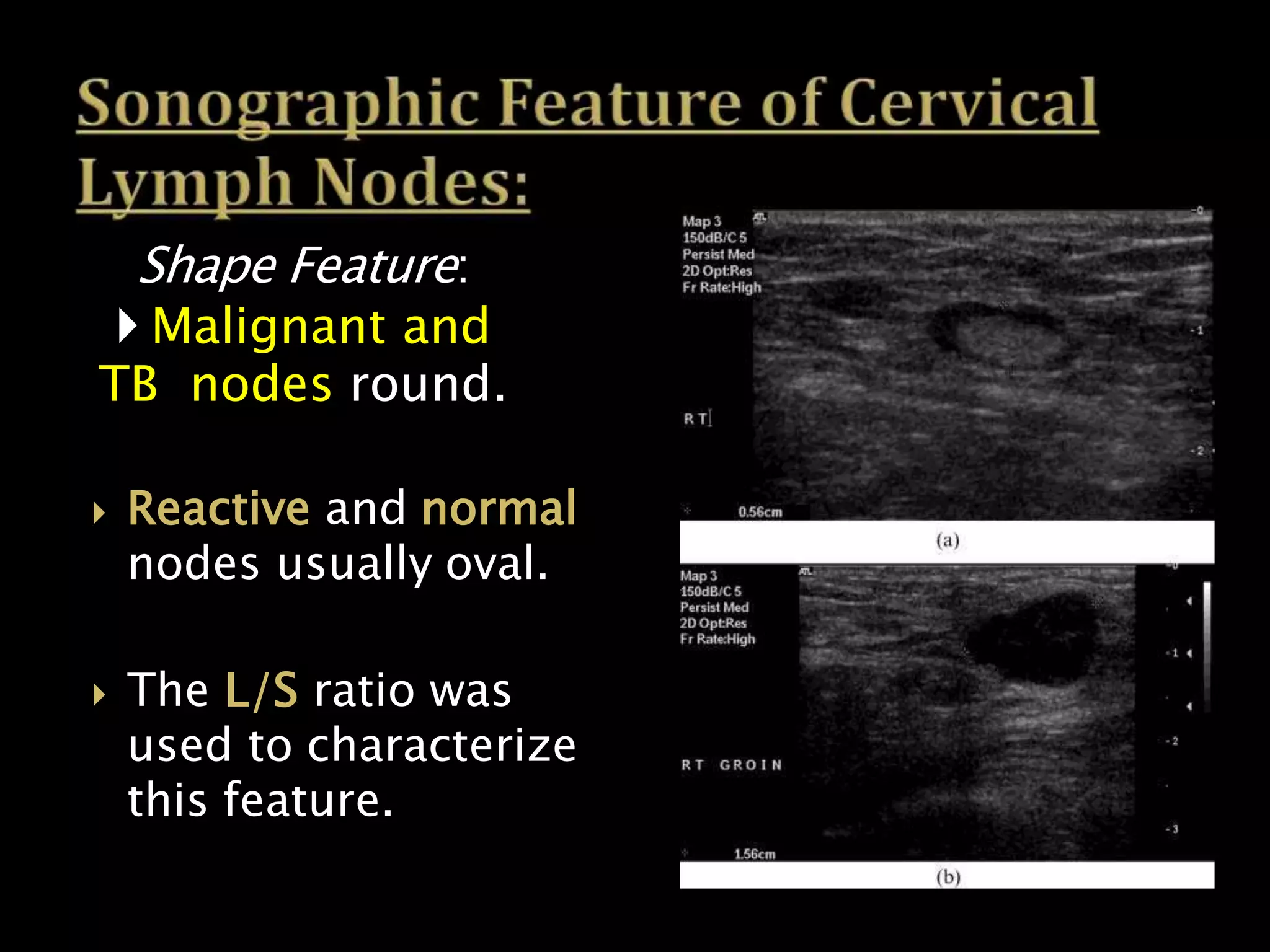 Imaging of cervical lymph nodes | PPTX