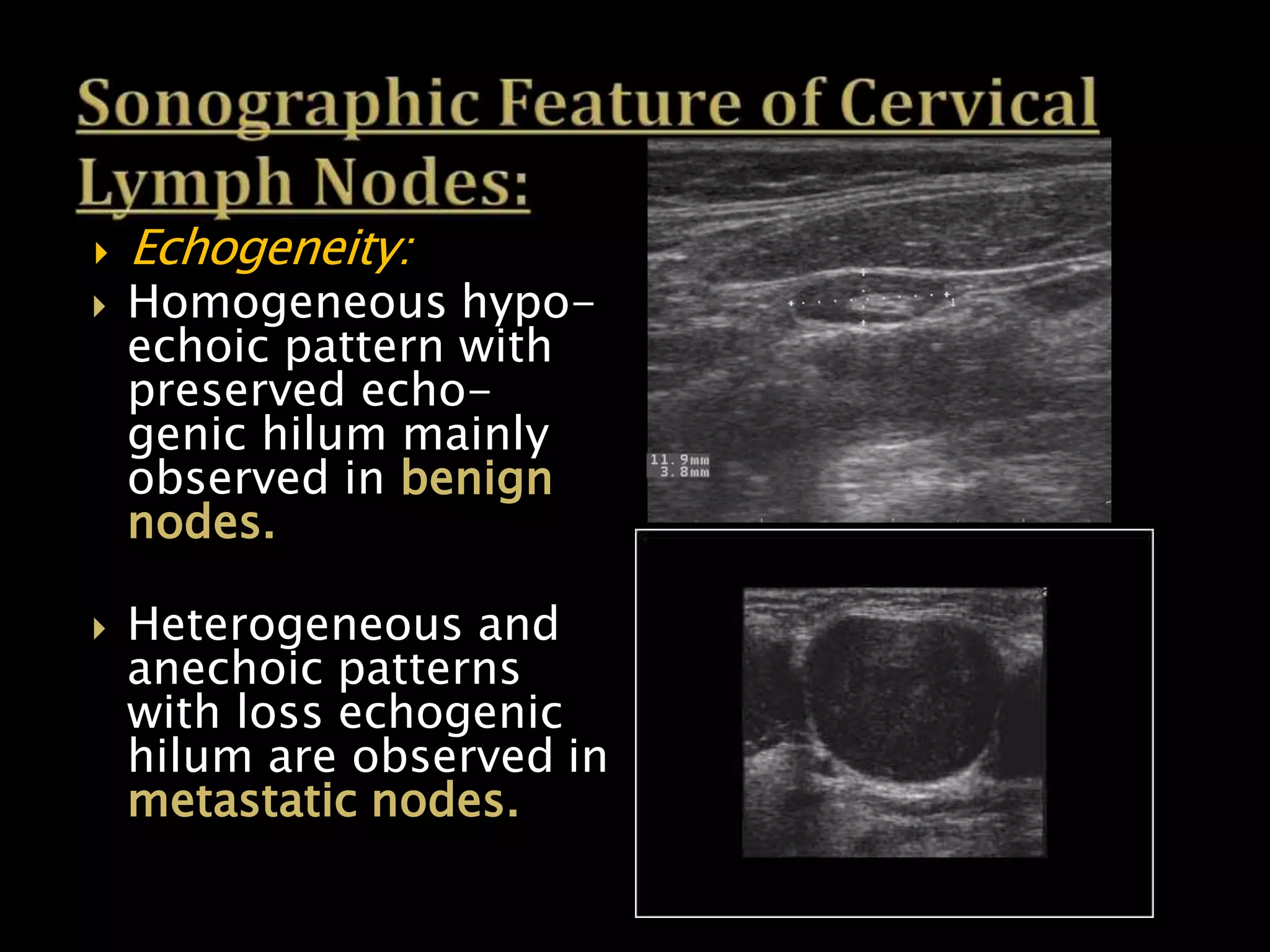 Imaging of cervical lymph nodes | PPTX