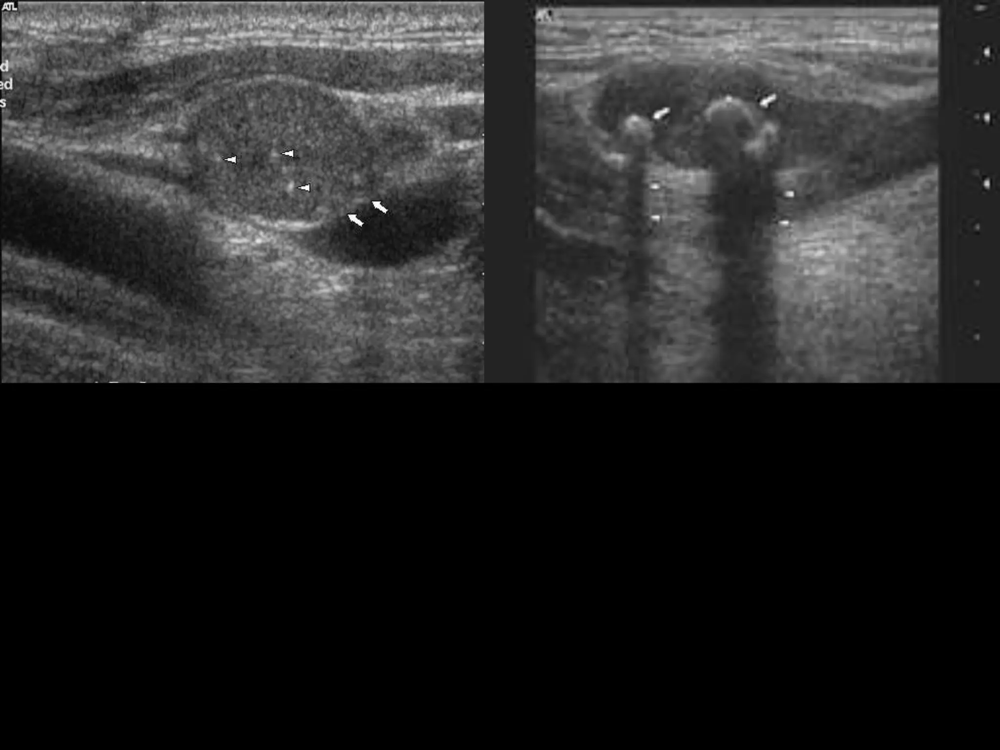 Imaging Of Cervical Lymph Nodes Ppt