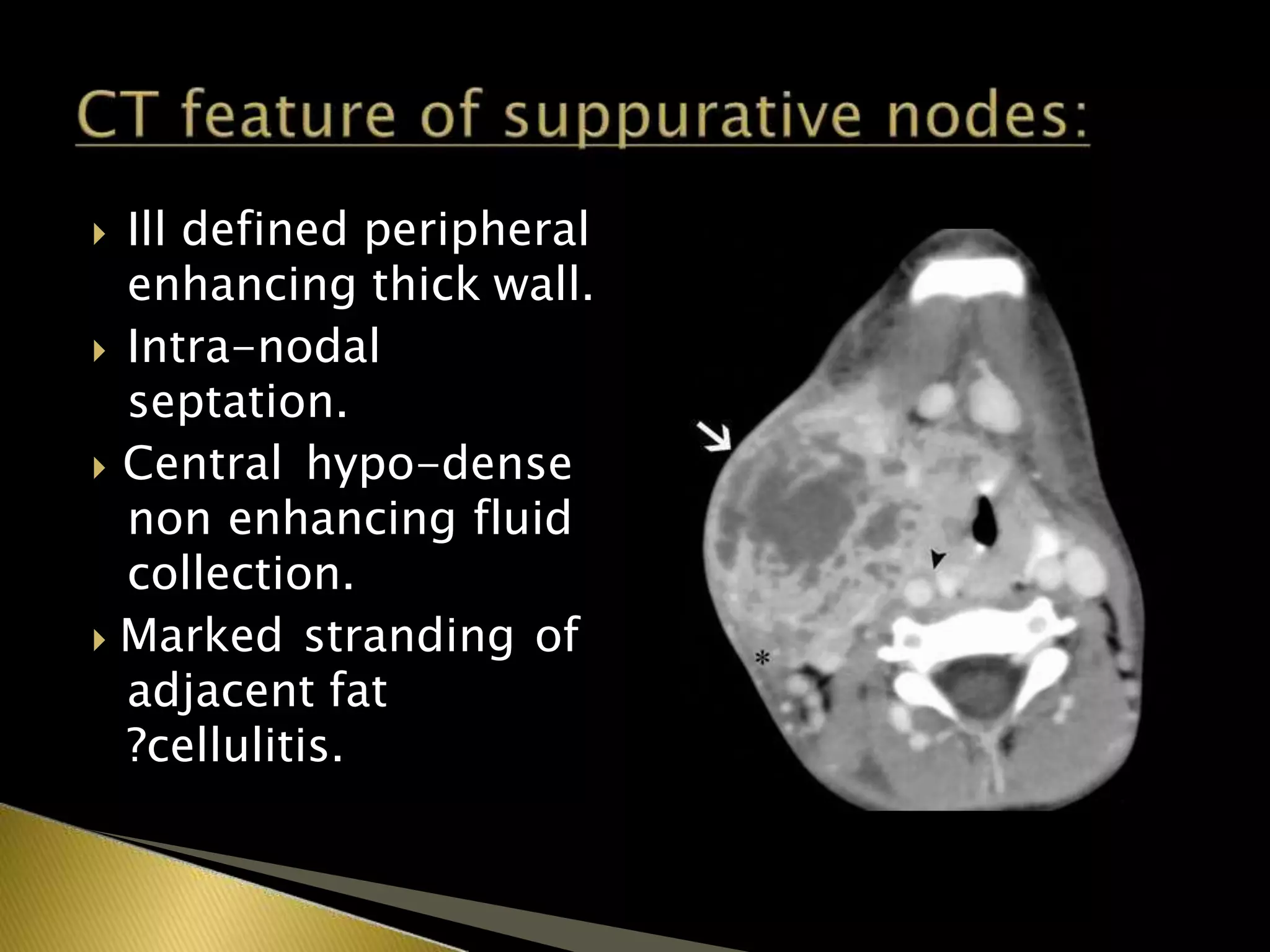 Imaging of cervical lymph nodes | PPTX