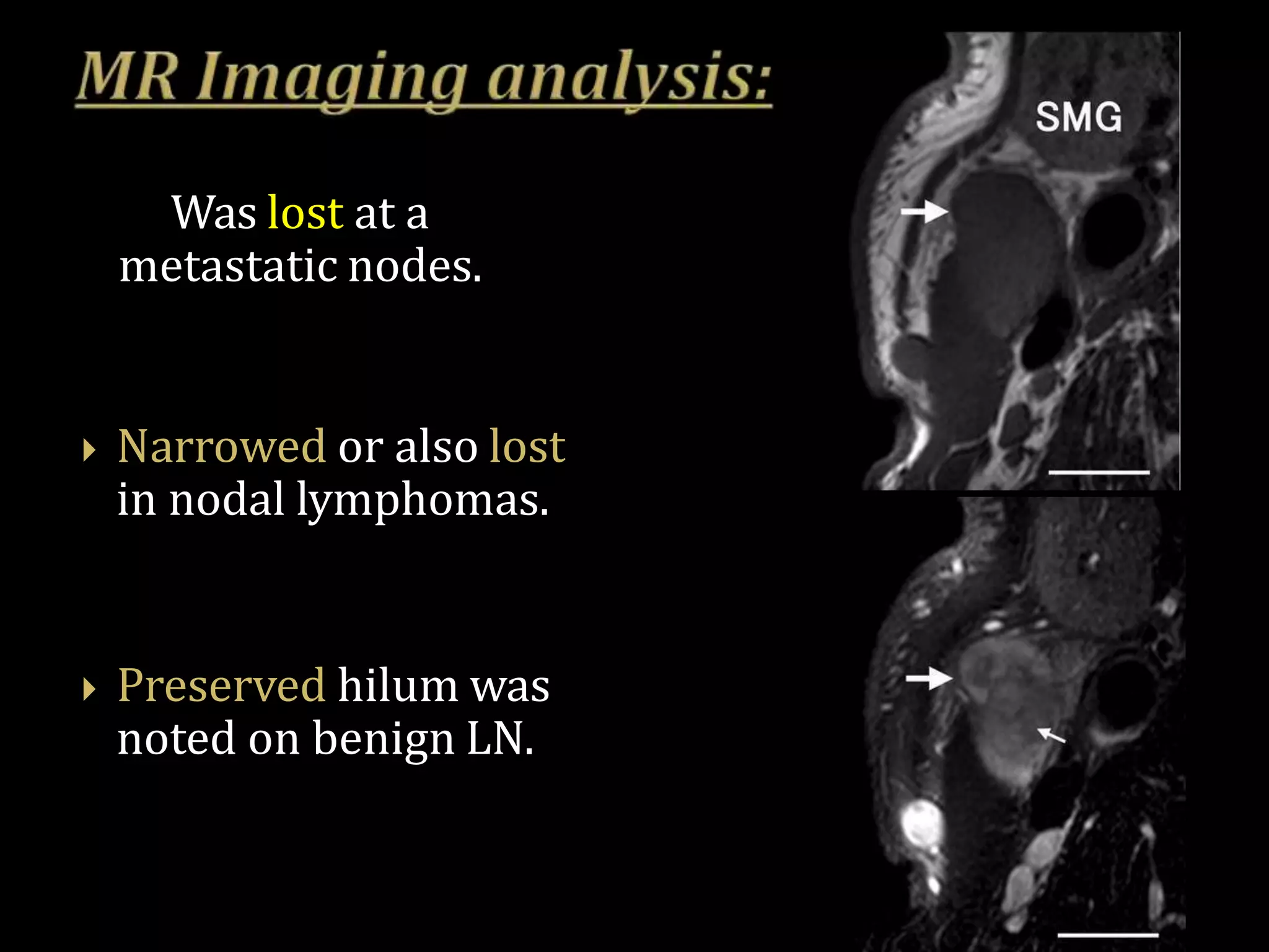 Imaging of cervical lymph nodes | PPTX