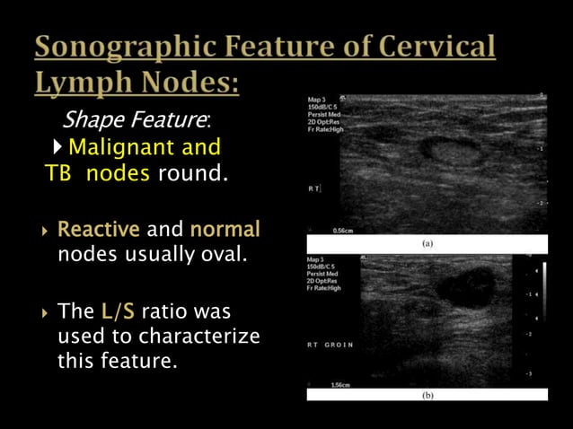 Imaging of cervical lymph nodes | PPTX