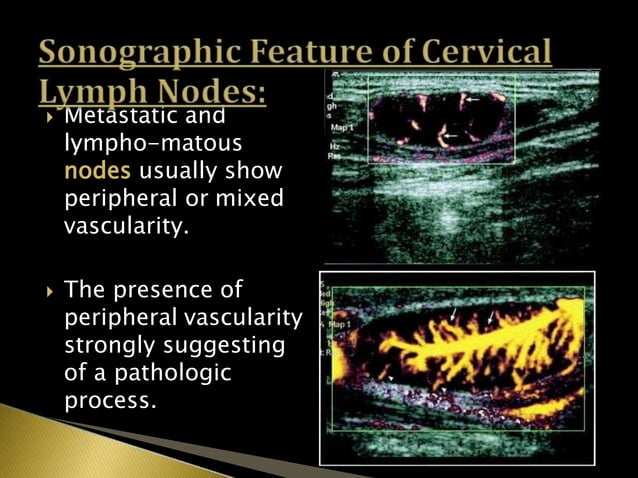 Imaging of cervical lymph nodes | PPTX
