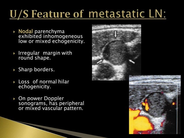 Imaging of cervical lymph nodes | PPTX