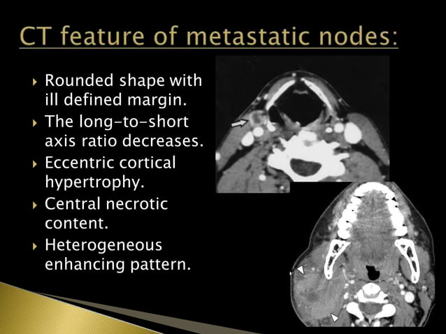 Imaging of cervical lymph nodes | PPTX