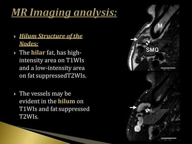 Imaging Of Cervical Lymph Nodes Ppt