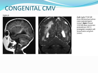 Imaging of cns viral infection | PPTX