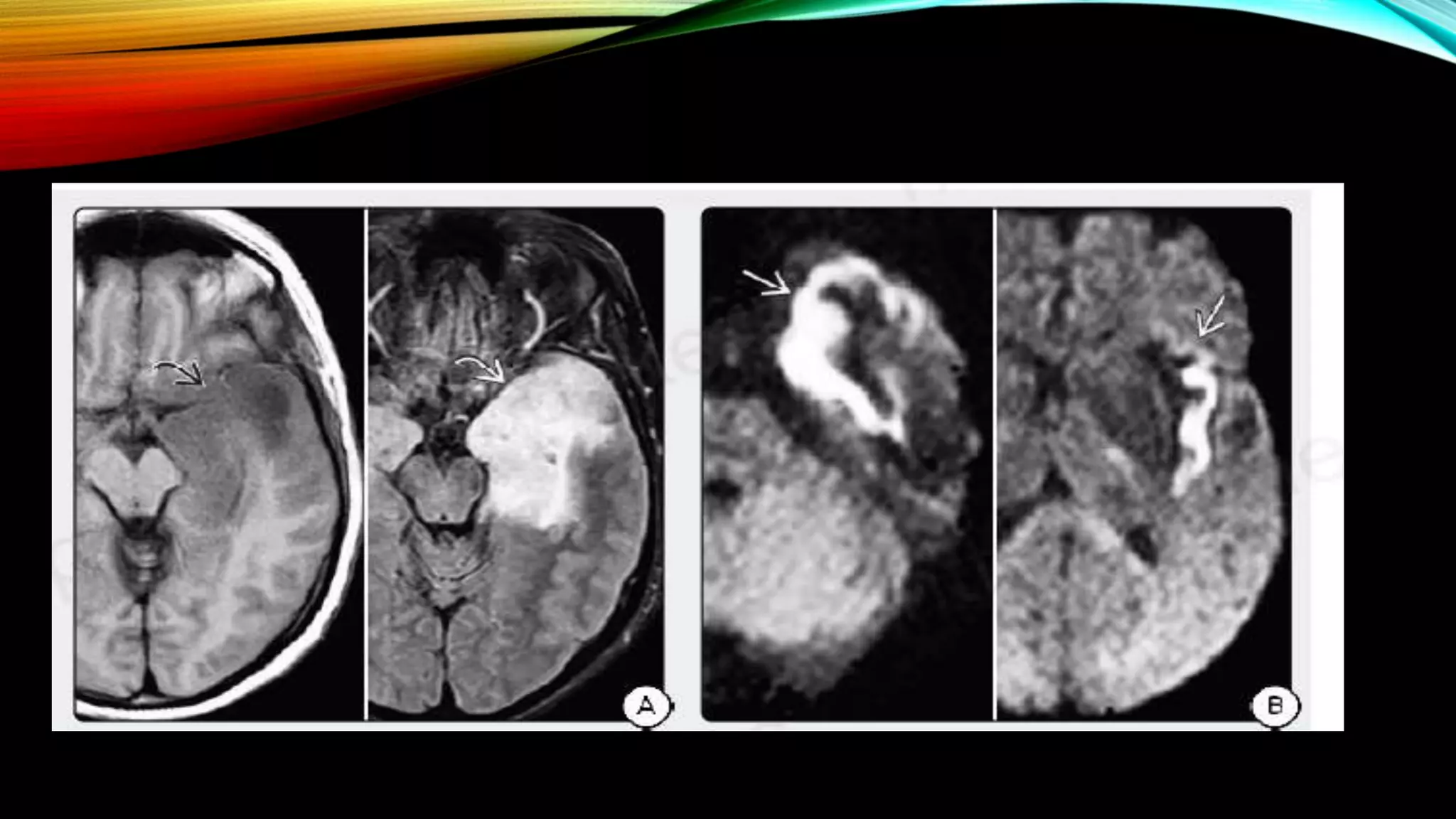 Imaging of common viral brain infection in india PPT | PPT