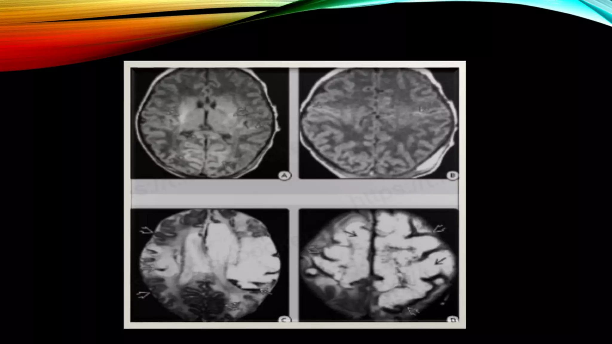 Imaging of common viral brain infection in india PPT | PPT