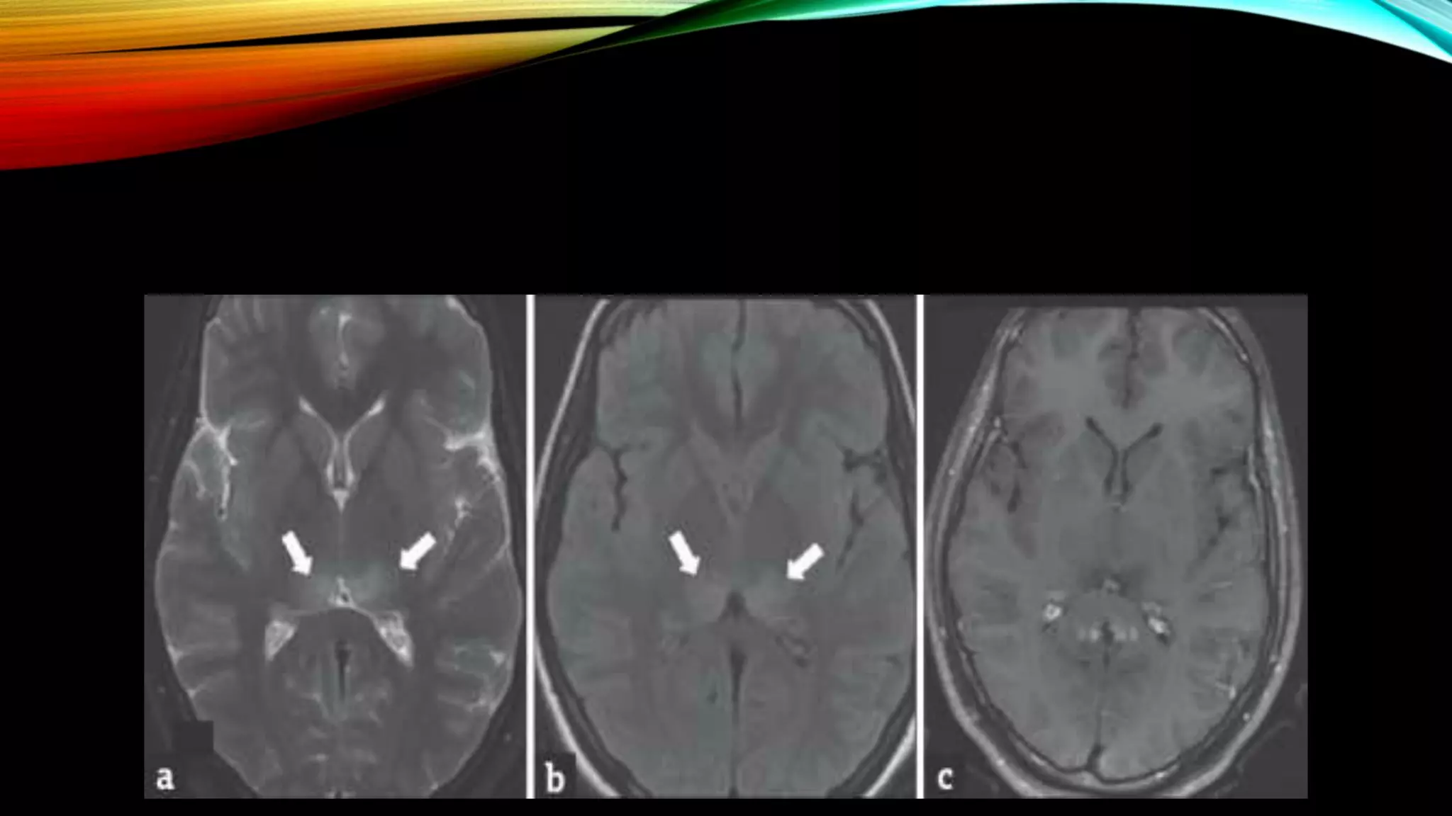 Imaging of common viral brain infection in india PPT | PPT
