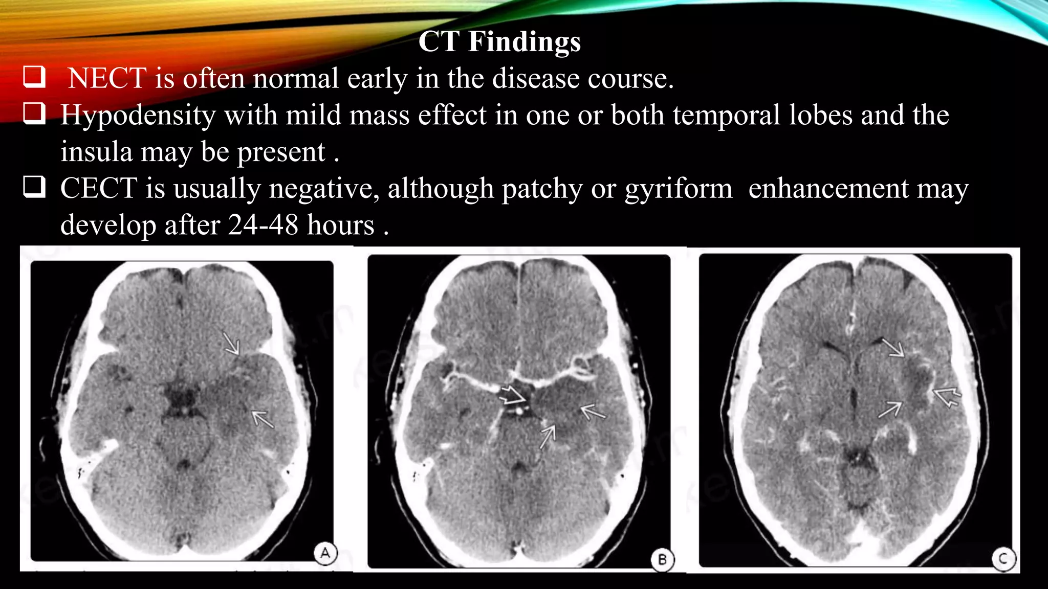 Imaging of common viral brain infection in india PPT | PPT