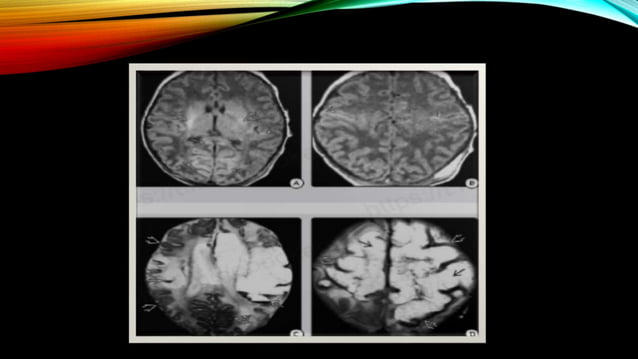 Imaging of common viral brain infection in india PPT | PPT
