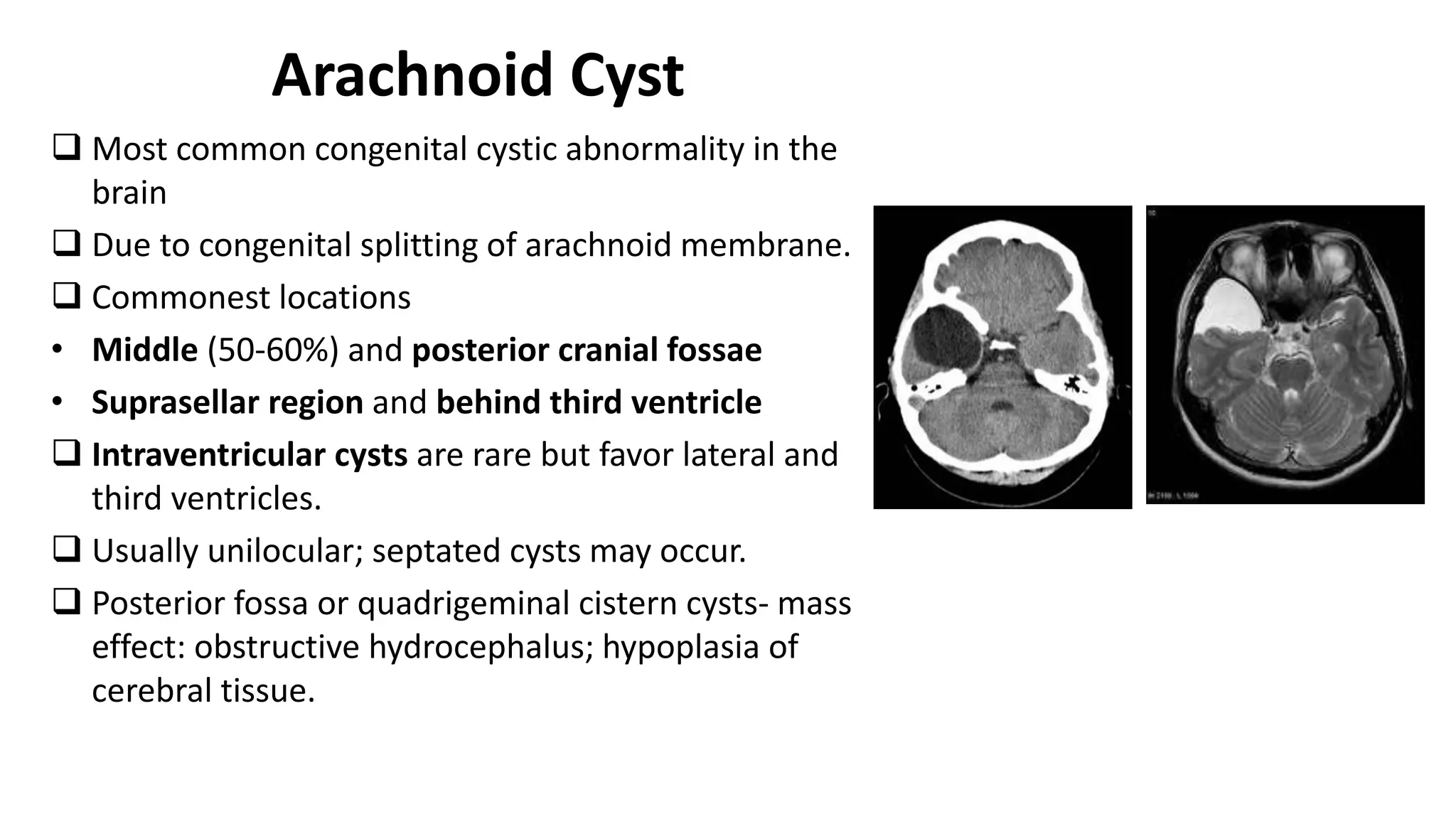 Imaging of congenital cns lesions | PPTX
