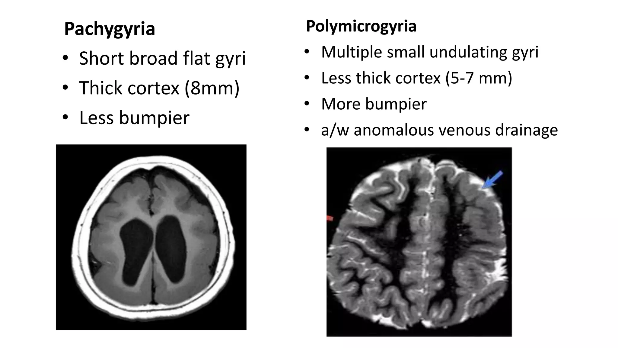 Imaging of congenital cns lesions | PPTX