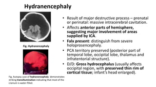 Imaging of congenital cns lesions | PPTX