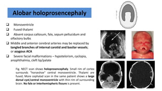 Imaging of congenital cns lesions | PPTX