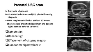 Imaging of congenital cns lesions | PPTX