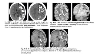 Imaging of congenital cns lesions | PPTX