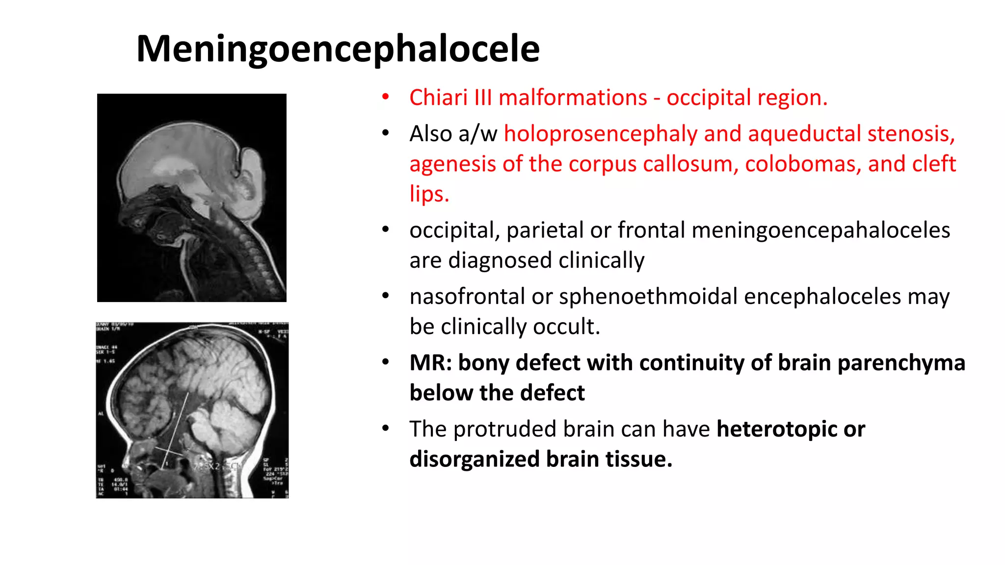 Imaging of congenital CNS lesions | PPTX