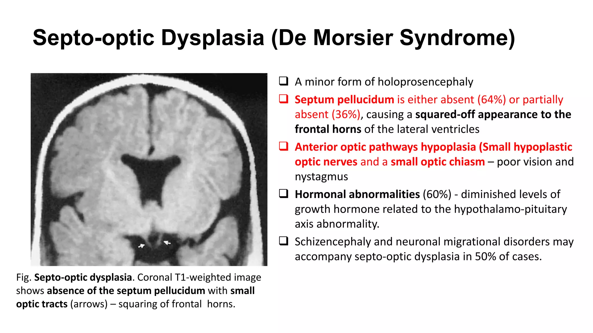 Imaging of congenital CNS lesions | PPTX
