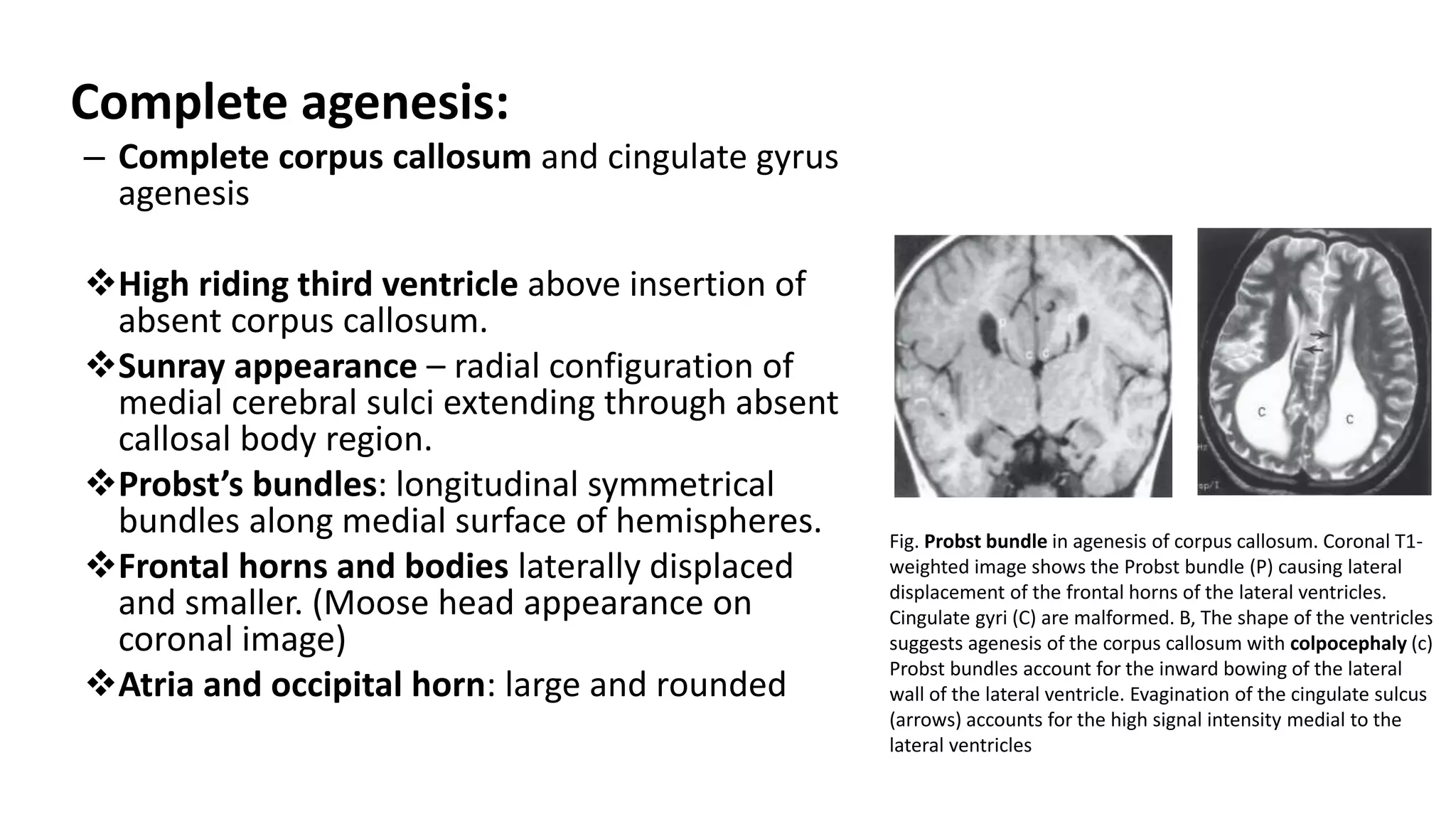 Imaging of congenital CNS lesions | PPTX
