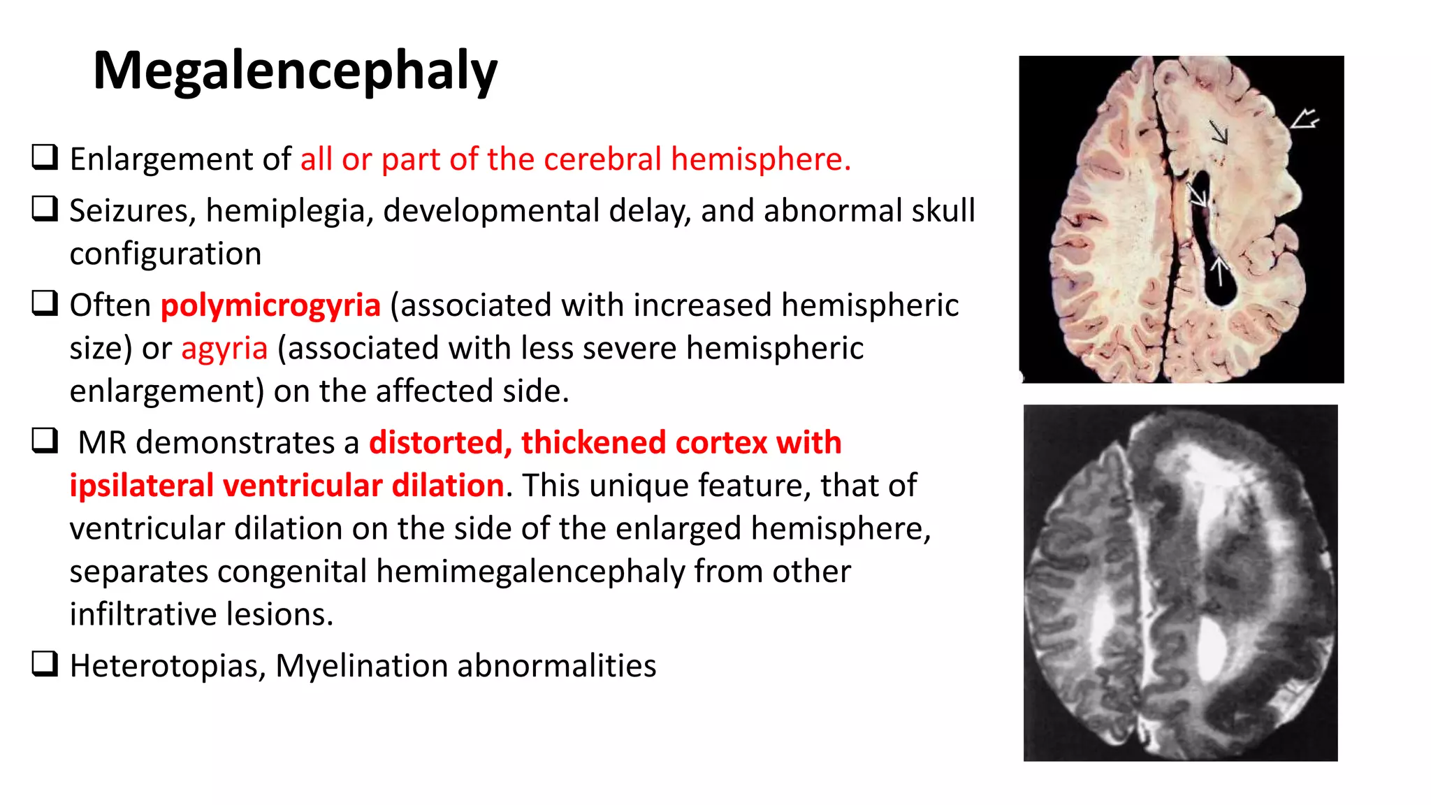 Imaging of congenital CNS lesions | PPT