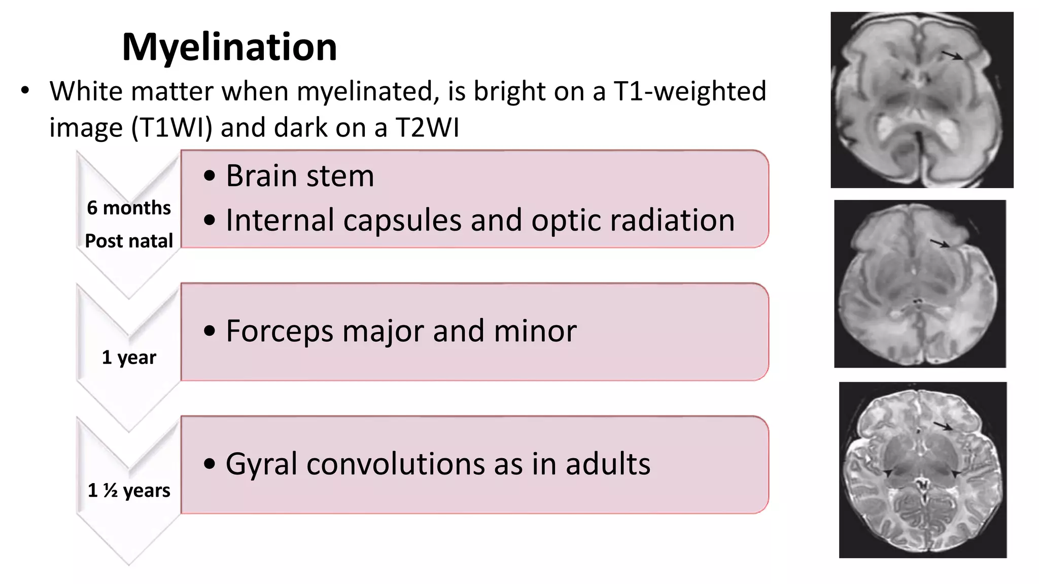 Imaging of congenital CNS lesions | PPTX