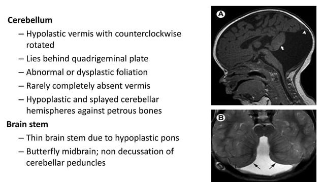 Imaging of congenital CNS lesions | PPTX