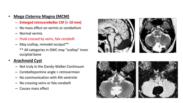 Imaging of congenital CNS lesions | PPT