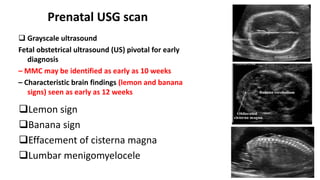 Imaging of congenital CNS lesions | PPTX