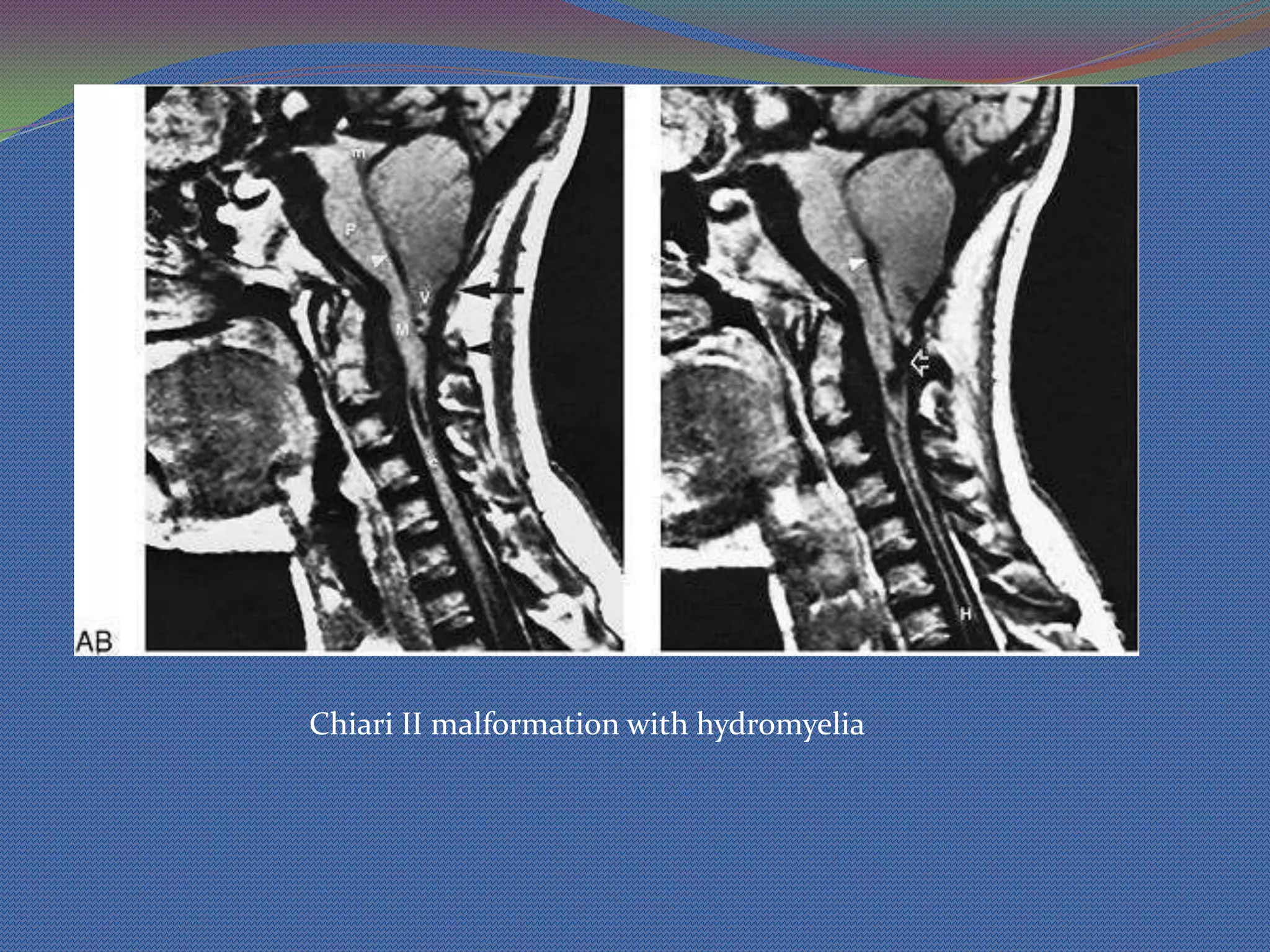 Imaging of congenital anomalies of spine and spinal cord | PPTX