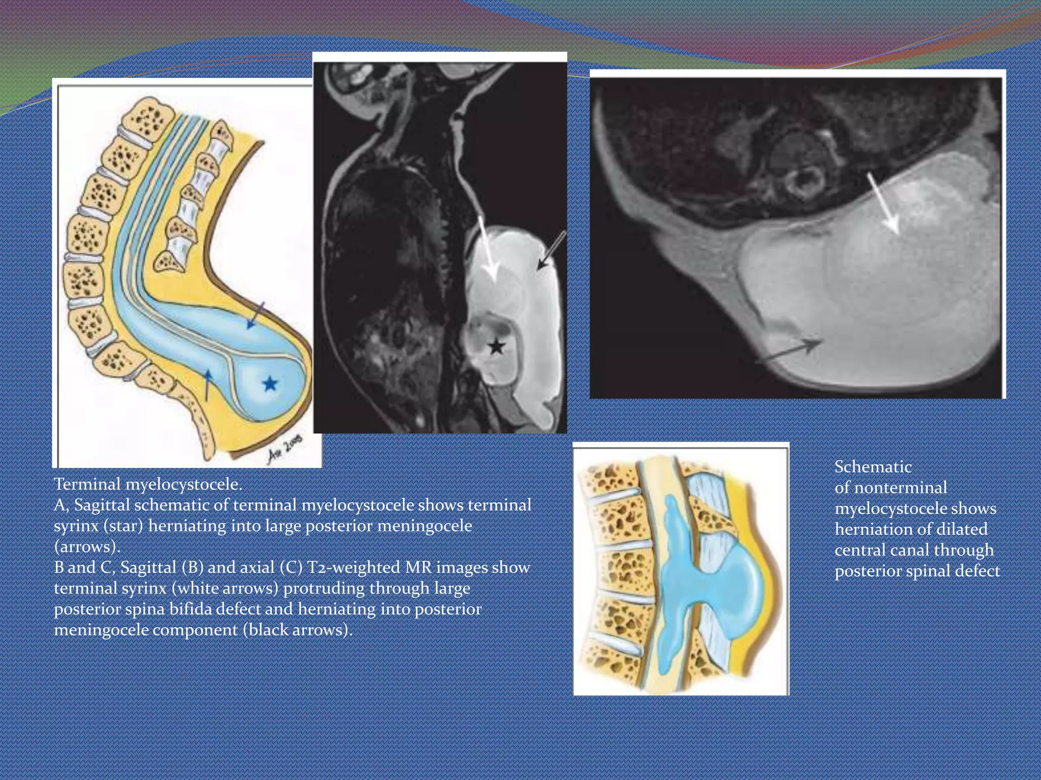Imaging of congenital anomalies of spine and spinal cord | PPTX