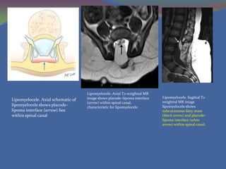 Imaging of congenital anomalies of spine and spinal cord | PPTX