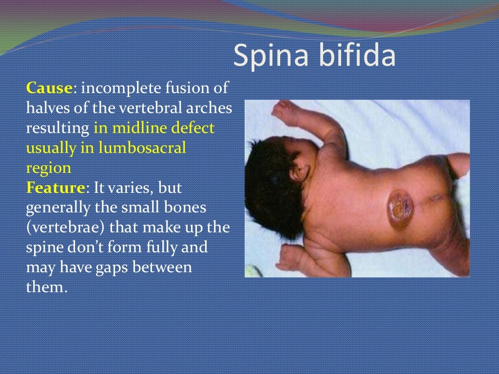 Imaging of congenital anomalies of spine and spinal cord