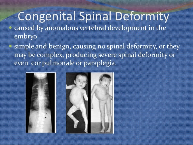 Imaging of congenital anomalies of spine and spinal cord