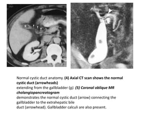 Imaging of cystic duct | PPTX
