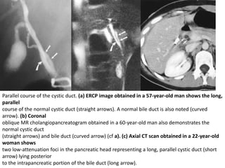 Imaging of cystic duct | PPTX