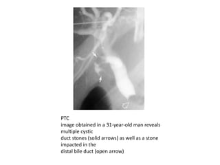 Imaging of cystic duct | PPTX