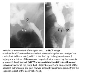 Imaging of cystic duct | PPTX