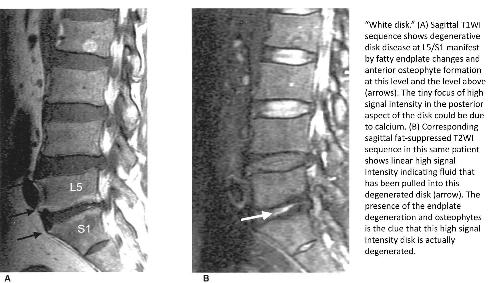 Imaging of lumbar spondylosis | PPTX