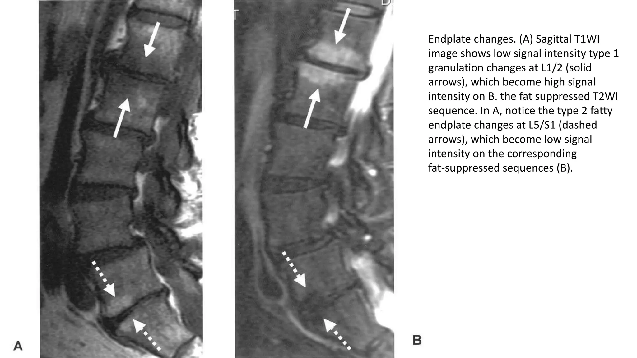 Imaging of lumbar spondylosis | PPTX