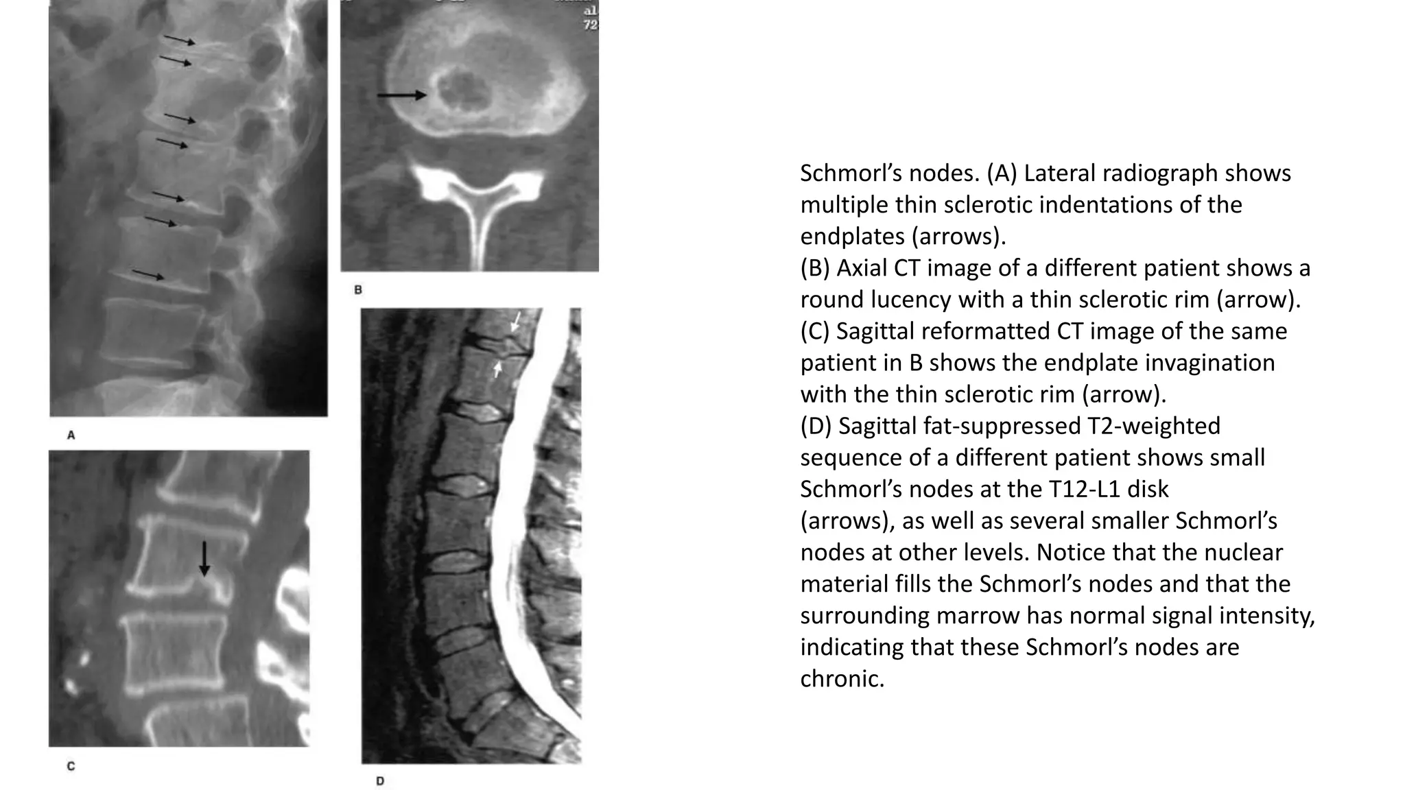 Imaging of lumbar spondylosis | PPTX