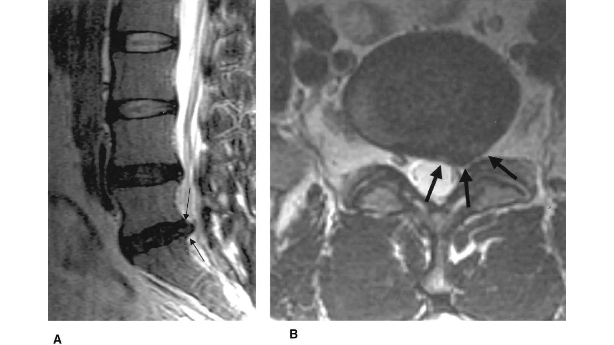 Imaging of lumbar spondylosis | PPTX