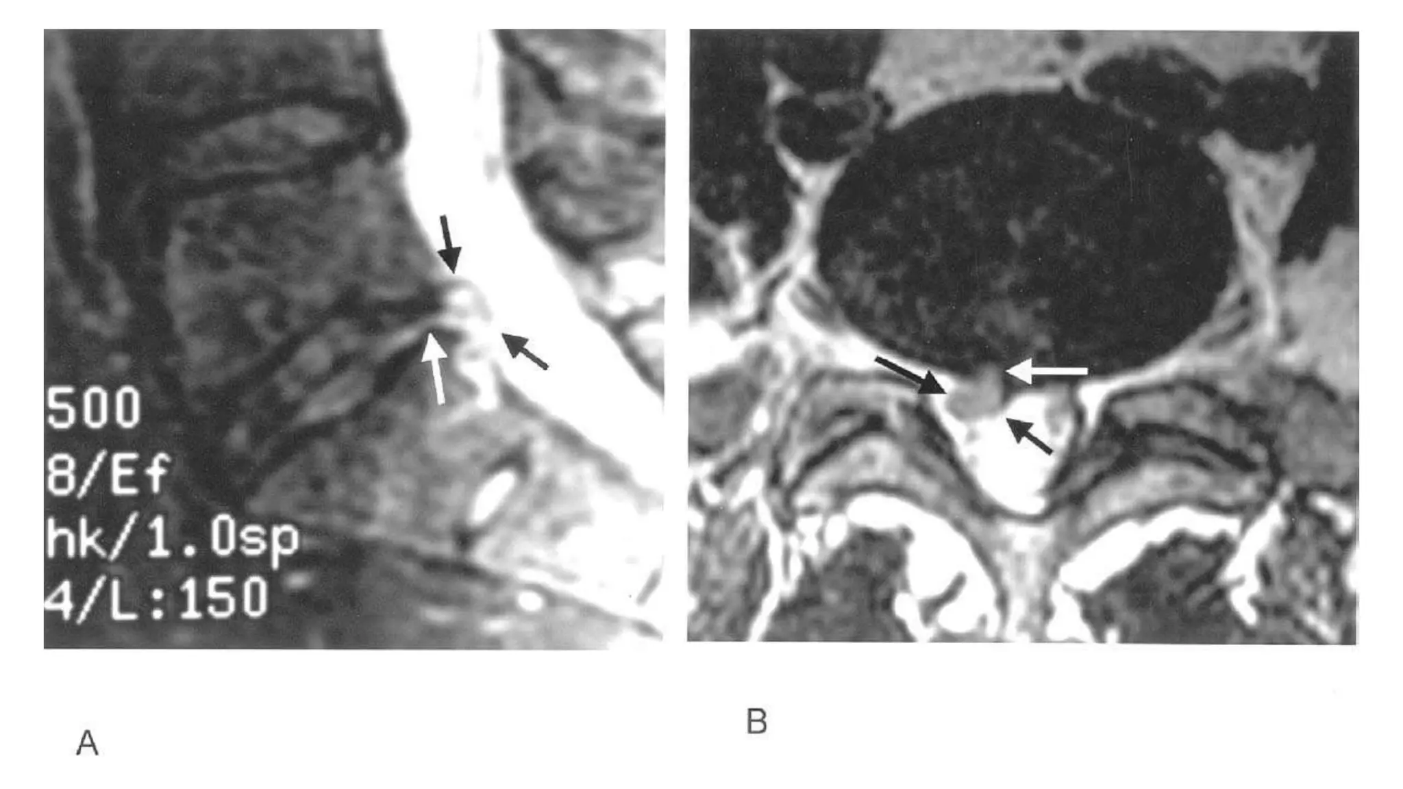 Imaging of lumbar spondylosis | PPTX