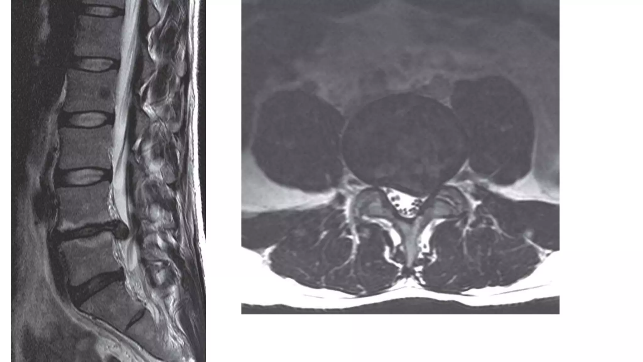 Imaging of lumbar spondylosis | PPTX
