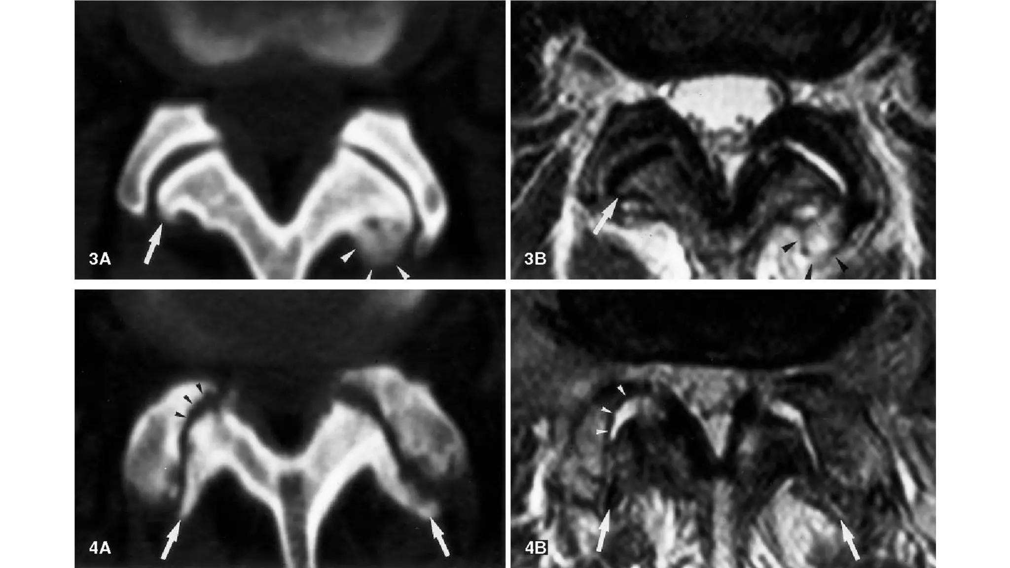 Imaging of lumbar spondylosis | PPTX