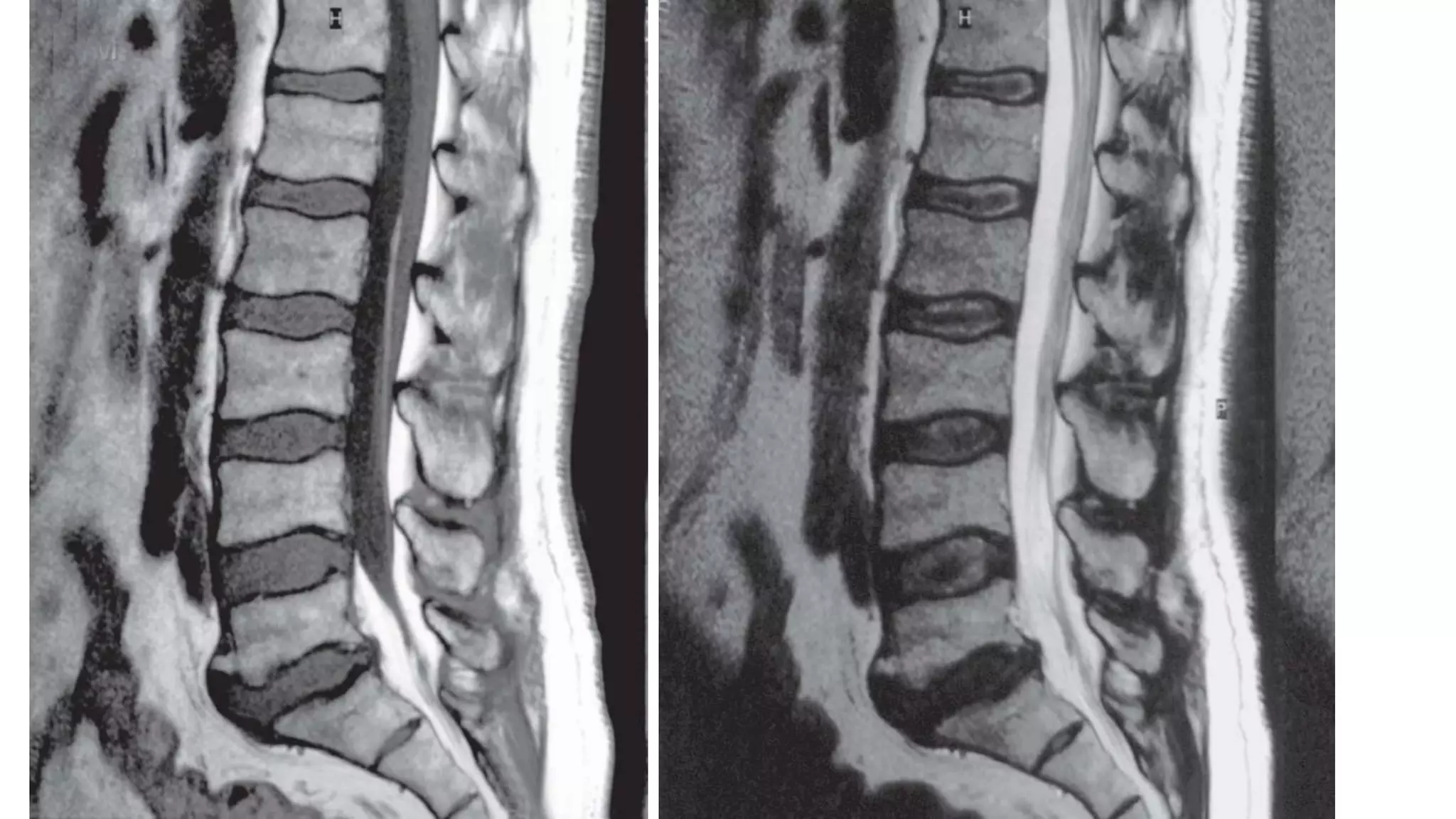 Imaging of lumbar spondylosis | PPTX
