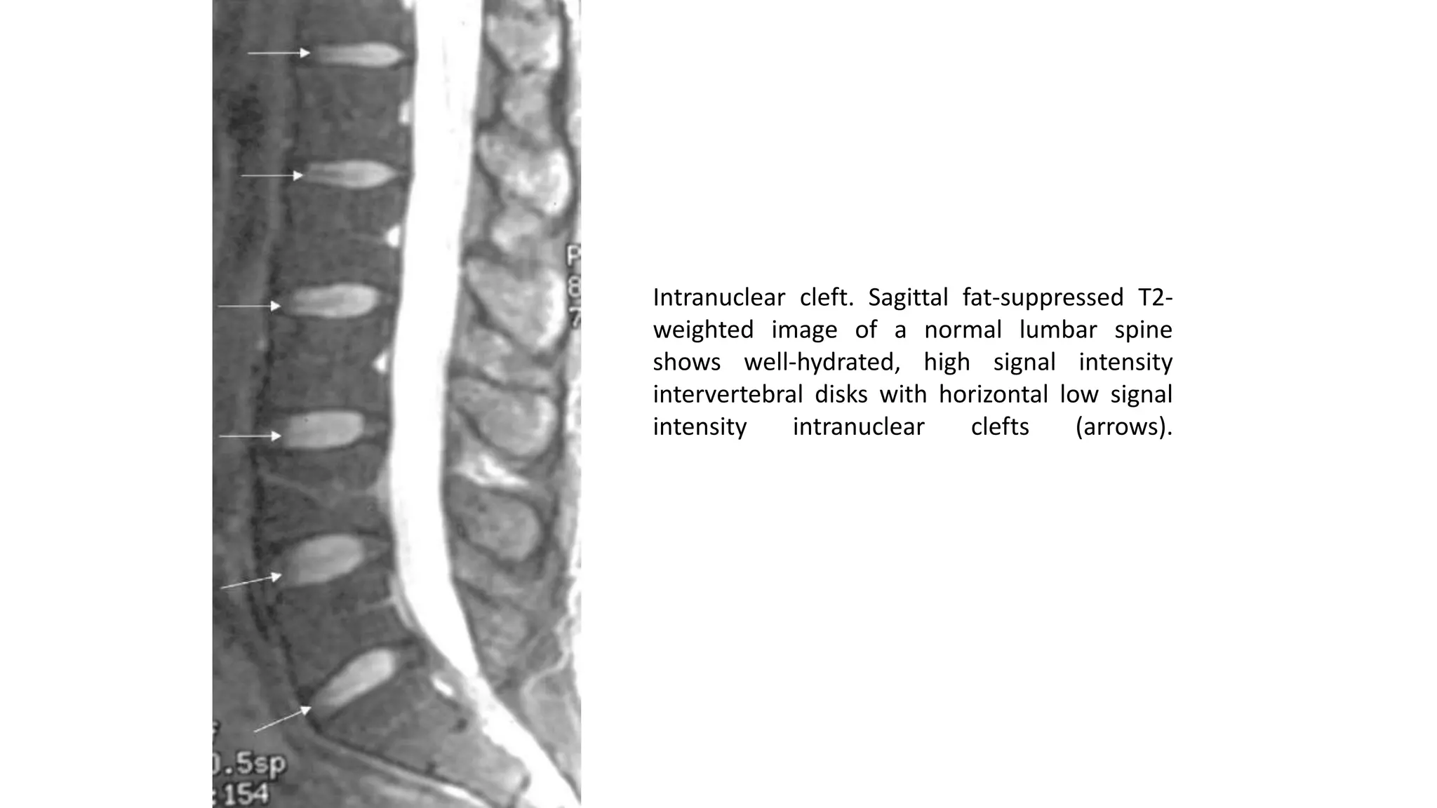 Imaging of lumbar spondylosis | PPTX