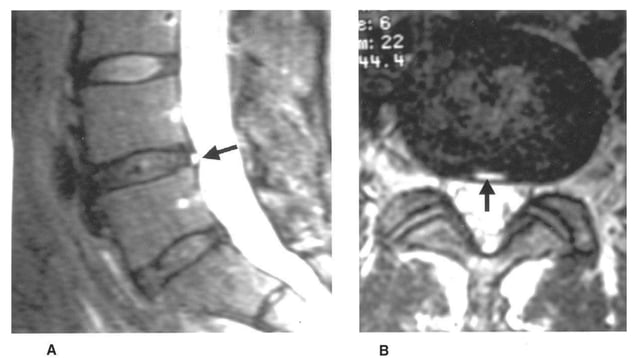 Imaging of lumbar spondylosis | PPTX